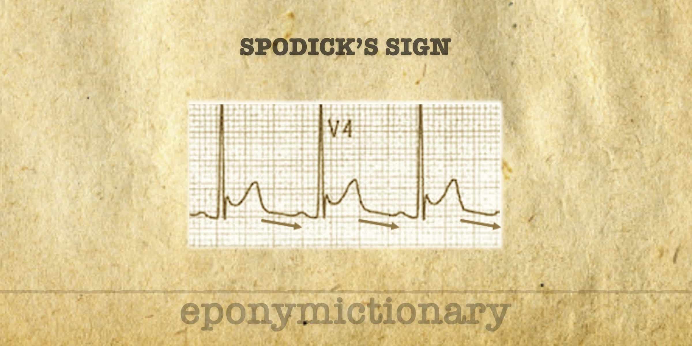 Spodick sign • LITFL • Medical Eponym Library