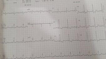 Crochetage sign • LITFL • ECG Library Diagnosis