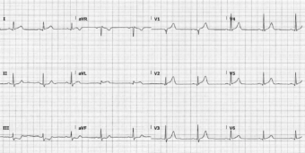Killer ECG Patterns: Part 2 • LITFL • ECG Library