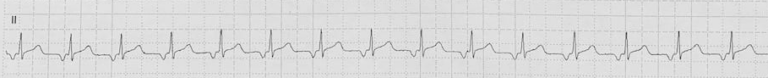 Focal Atrial Tachycardia (FAT) • LITFL • ECG Library Diagnosis