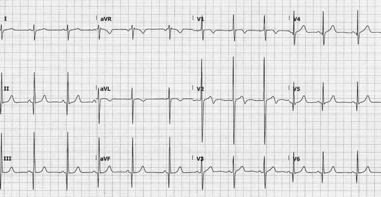Hypertrophic Cardiomyopathy (HCM) • LITFL • ECG Library Diagnosis