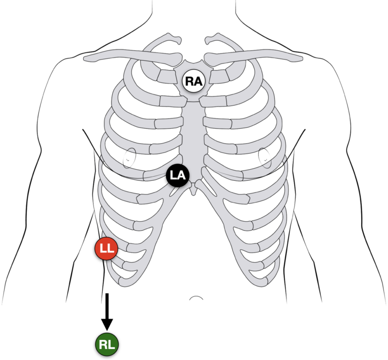 Lewis lead • LITFL • Medical Eponym Library