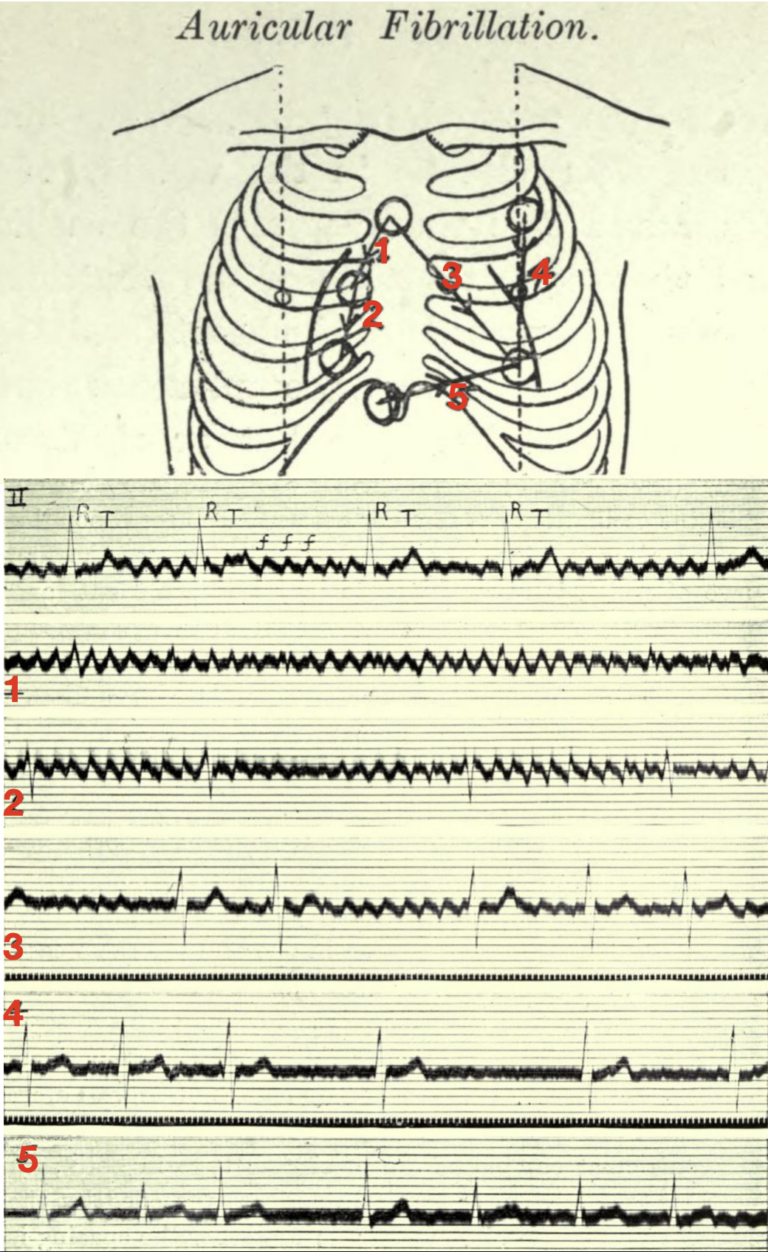 ECG Lead positioning • LITFL • ECG Library Basics