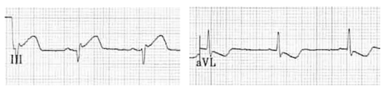 ECG Case 127 • LITFL • ECG Top 100 Self-Assessment Quiz