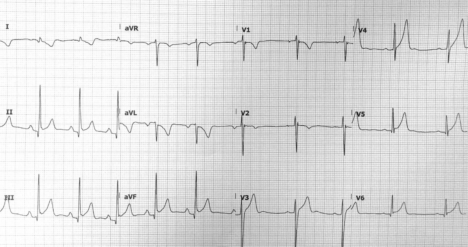 Borderline Ecg