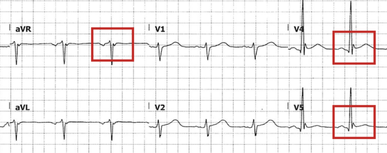 ECG Case 126 • LITFL • ECG Top 100 Self-Assessment Quiz