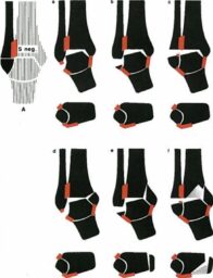 Bernhard Weber • LITFL • Medical Eponym Library