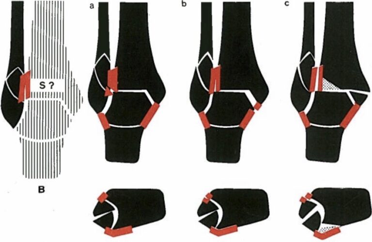 Danis-Weber classification • LITFL • Medical Eponym Library