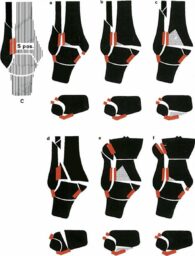 Danis-Weber classification • LITFL • Medical Eponym Library