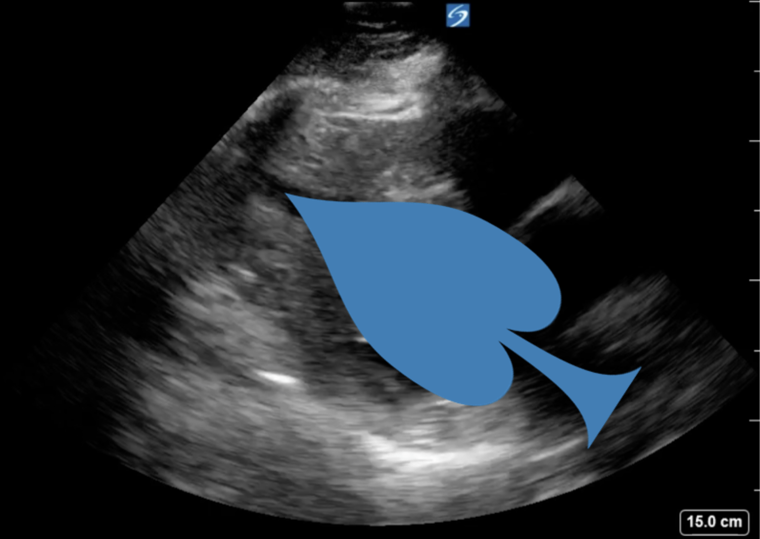 ECG Case 129 • LITFL • ECG Top 100 Self-Assessment Quiz