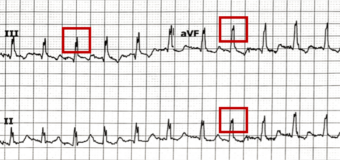 ECG Case 130 • LITFL • ECG Top 100 Self-Assessment Quiz