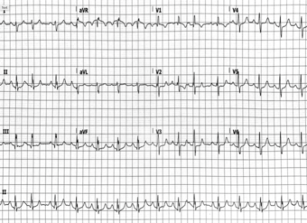 Crochetage sign • LITFL • ECG Library Diagnosis