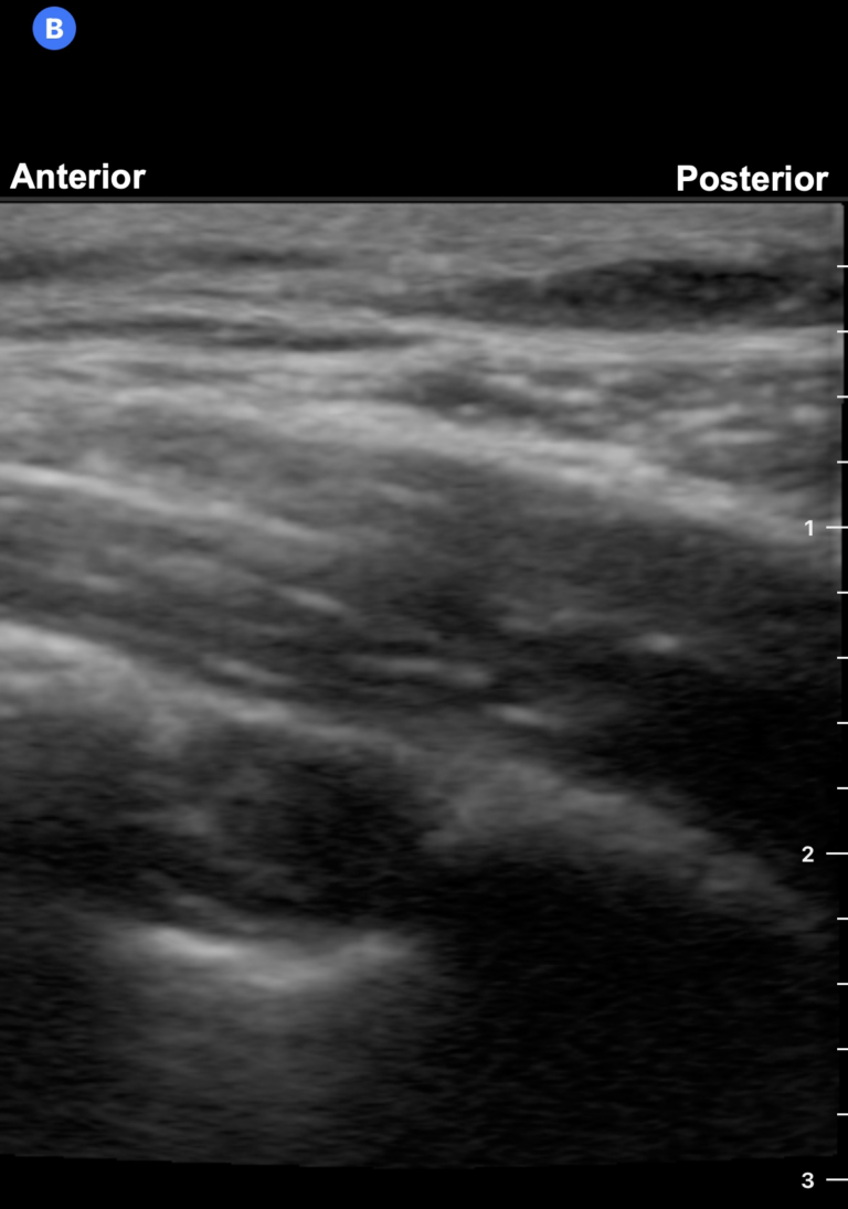 Serratus Anterior Plane Block • LITFL • Nerve Block Library