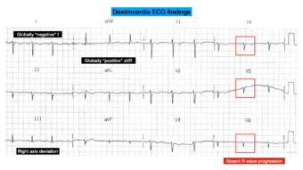 ECG Case 134 • LITFL • ECG Top 100 Self-Assessment Quiz