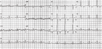 ECG Case 132 • LITFL • ECG Top 100 Self-Assessment Quiz