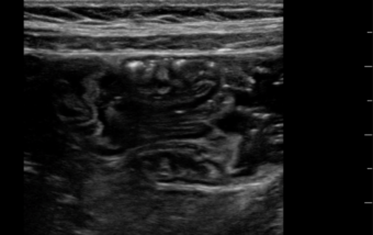 Ultrasound Case 109 • LITFL • POCUS Top 100
