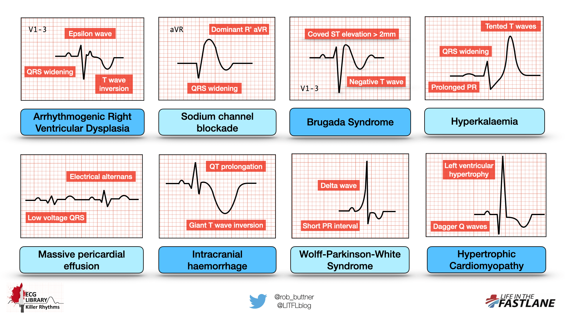 Killer ECG Patterns Part LITFL ECG Library 52 OFF Killer ECG Patterns Part LITFL ECG Library 52 OFF