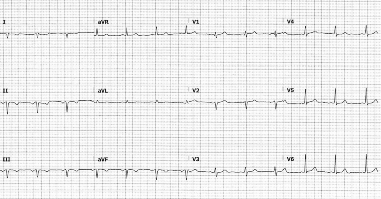 ECG Case 134 • LITFL • ECG Top 100 Self-Assessment Quiz