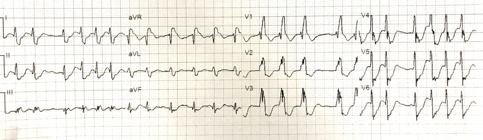 ST Elevation in aVR • LITFL • ECG Library Diagnosis