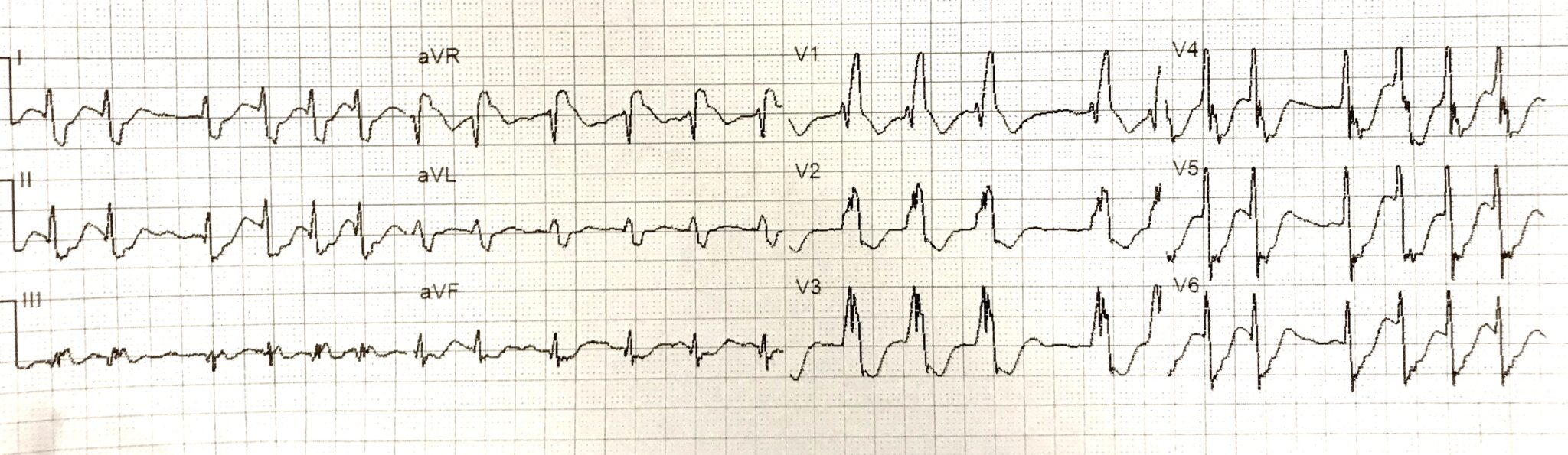 ST Elevation in aVR • LITFL • ECG Library Diagnosis