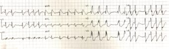 ST Elevation in aVR • LITFL • ECG Library Diagnosis