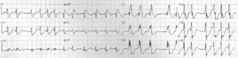 ECG Case 133 • LITFL • ECG Top 100 Self-Assessment Quiz