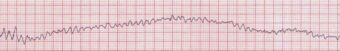 Ventricular Fibrillation (VF) • LITFL • ECG Library Diagnosis