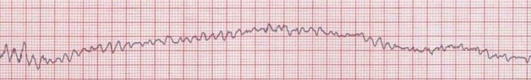 Ventricular Fibrillation (VF) • LITFL • ECG Library Diagnosis