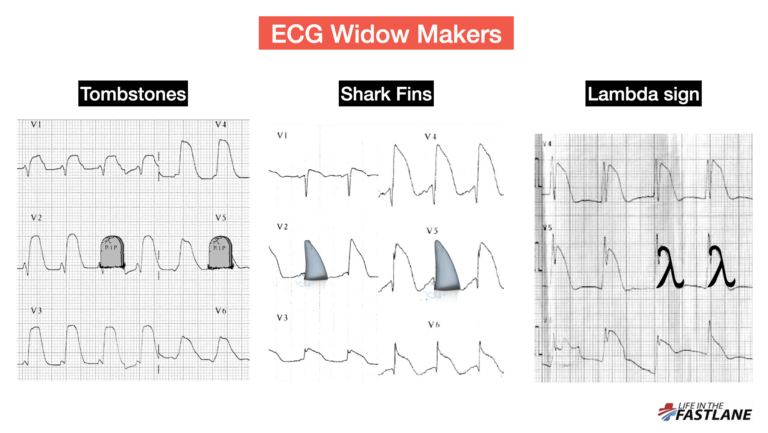 ECG Case 026 • LITFL • ECG Top 100 Self-Assessment Quiz