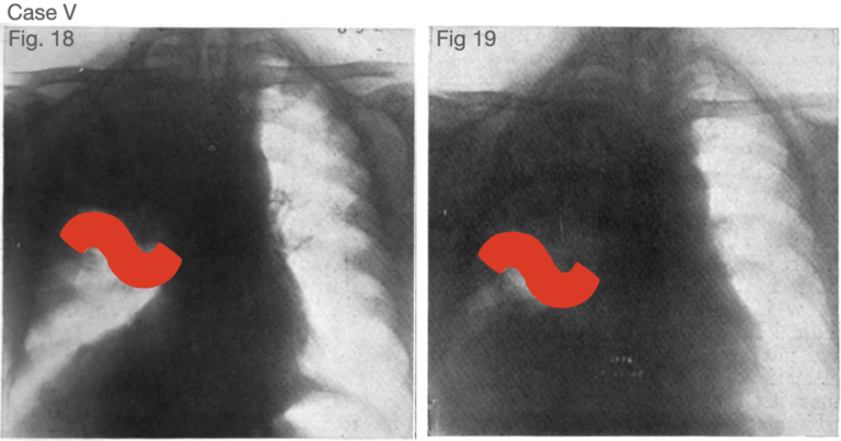 Golden S sign • LITFL • Medical Eponym Library