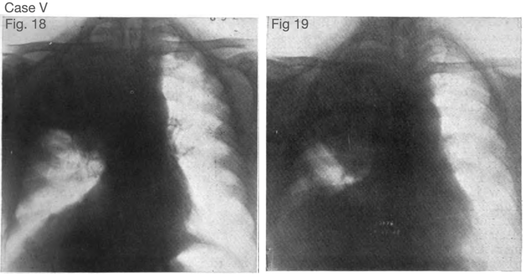 Golden S sign • LITFL • Medical Eponym Library