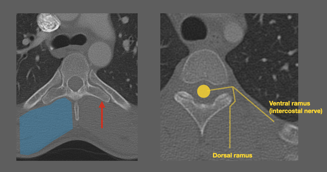 Erector Spinae Plane Block • LITFL • Nerve Block Library