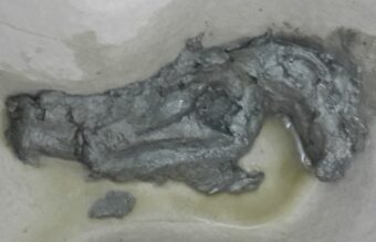 Thomas sign • LITFL • Medical Eponym Library