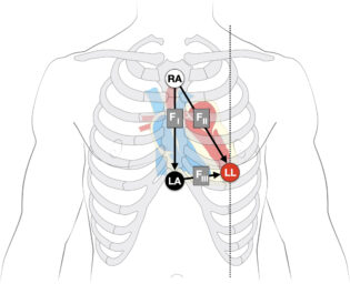 Arrhythmogenic Right Ventricular Dysplasia (ARVD) • ECG Library