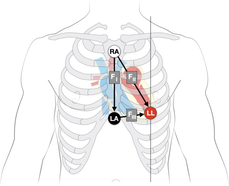 Arrhythmogenic Right Ventricular Dysplasia (ARVD) • ECG Library
