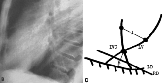 Hoffman-Rigler sign • LITFL • Medical Eponym Library
