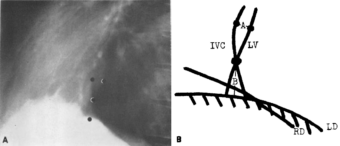 Hoffman-Rigler sign • LITFL • Medical Eponym Library
