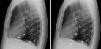 Hoffman-Rigler sign • LITFL • Medical Eponym Library