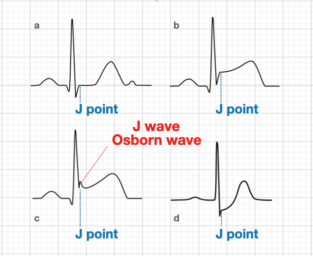 Osborn Wave (J Wave) • LITFL • ECG Library Basics