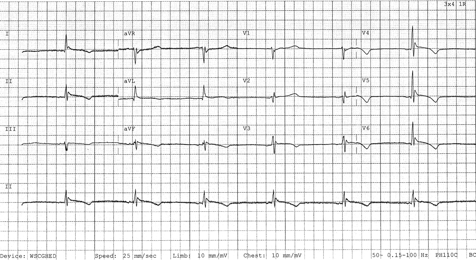 Osborn Wave (J Wave) • LITFL • ECG Library Basics