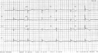 Osborn Wave (J Wave) • LITFL • ECG Library Basics