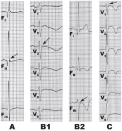 Fontaine lead • LITFL • Medical Eponym Library