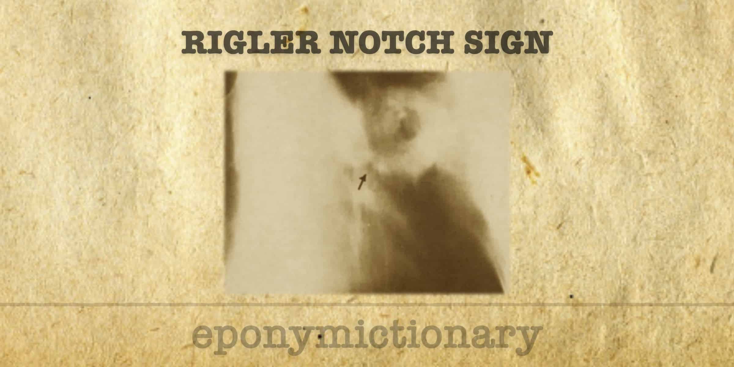Rigler notch sign • LITFL • Medical Eponym Library