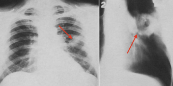 Rigler notch sign • LITFL • Medical Eponym Library