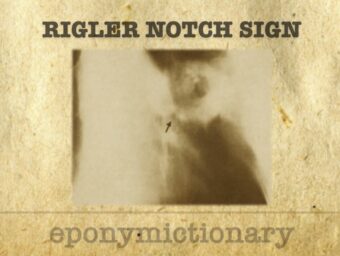 Rigler notch sign Archives • LITFL