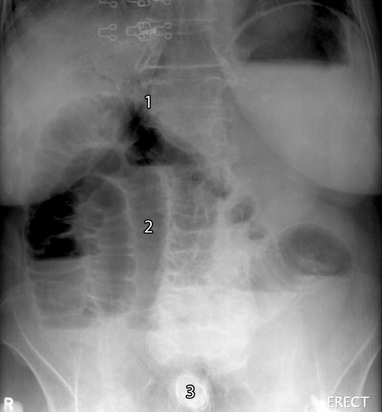 Rigler triad • LITFL • Medical Eponym Library
