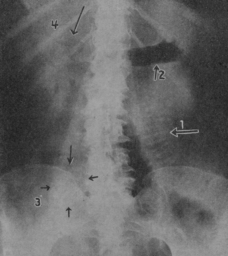 Rigler triad • LITFL • Medical Eponym Library