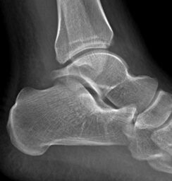 Shepherd fracture • LITFL • Medical Eponym Library
