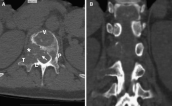 Winking owl sign • LITFL • Medical Eponym Library