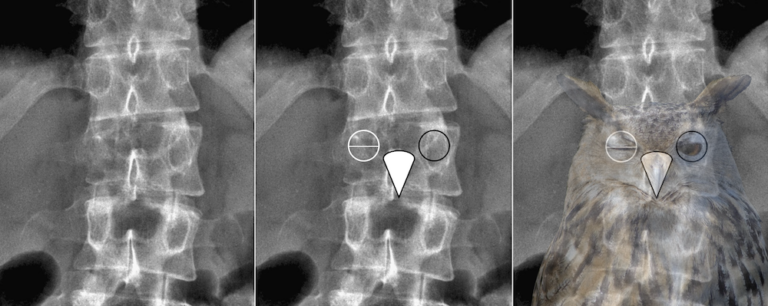 Winking owl sign • LITFL • Medical Eponym Library